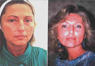 Exoderm Peel Nido Biofibre FUE Hair Transplant Plastic Surgeries